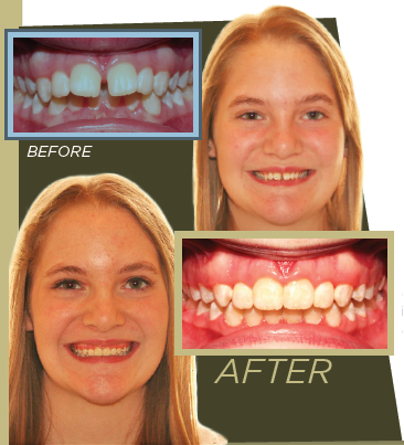 Severe Overbite Smile